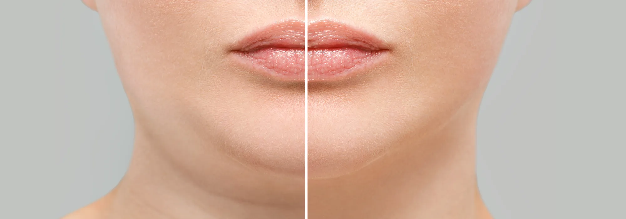 "Double Chin" Refined With EndoliftX – A New Facelift Technology
