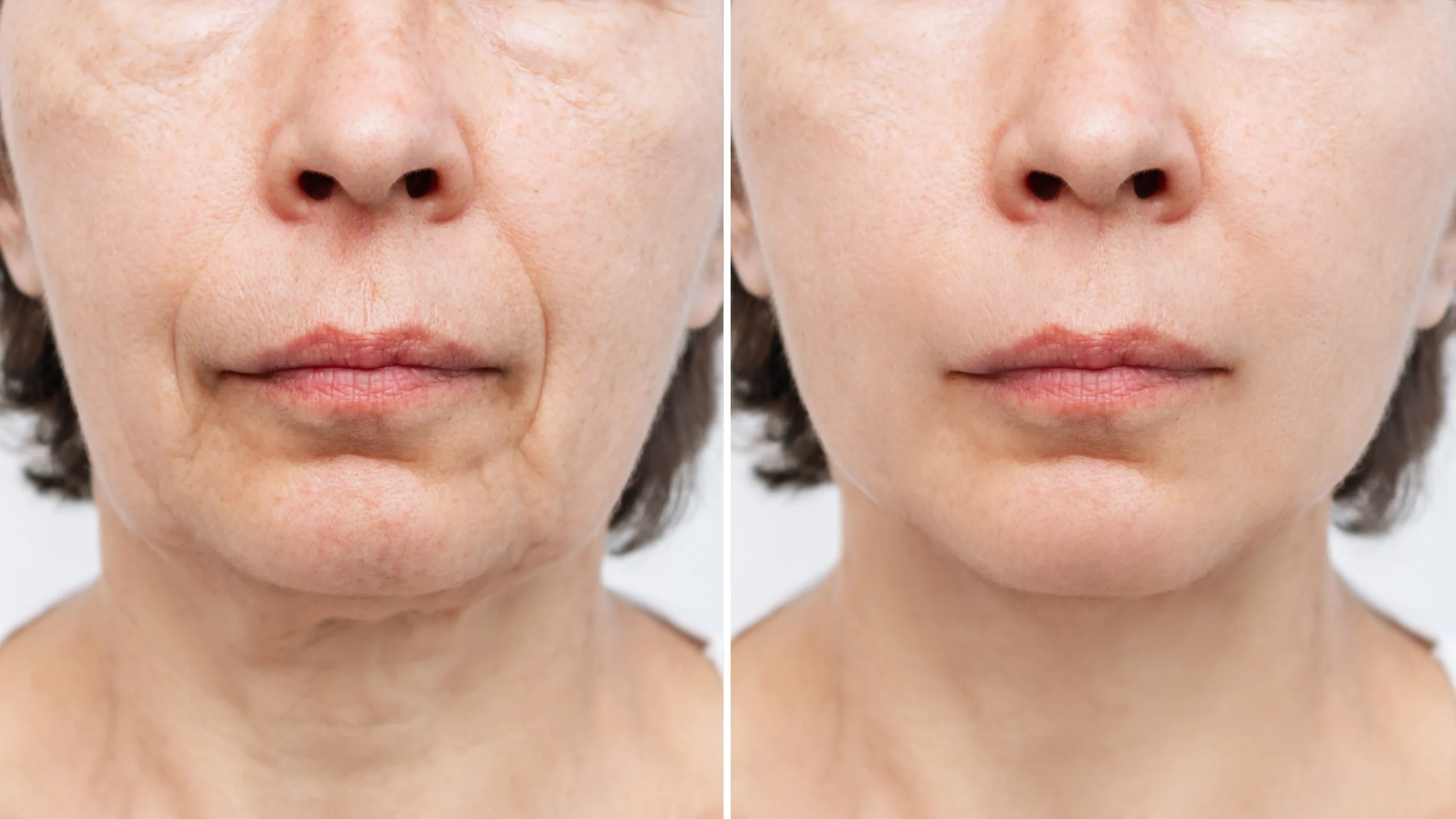 Facial Sagging, Drooping Cheeks, and Double Chin: Are They Caused by ...
